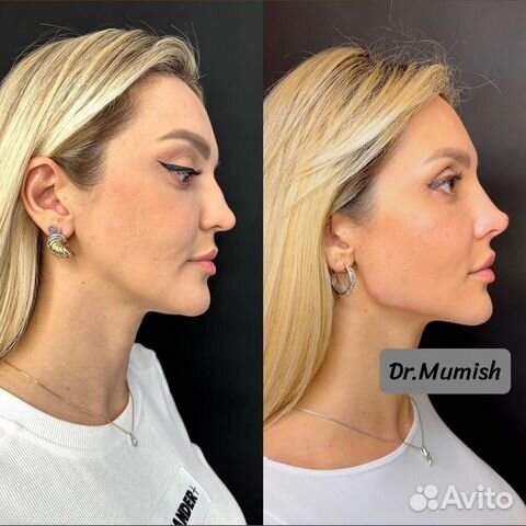 Губы, джоли, скулы, подбородок в Москве | Услуги | Авито